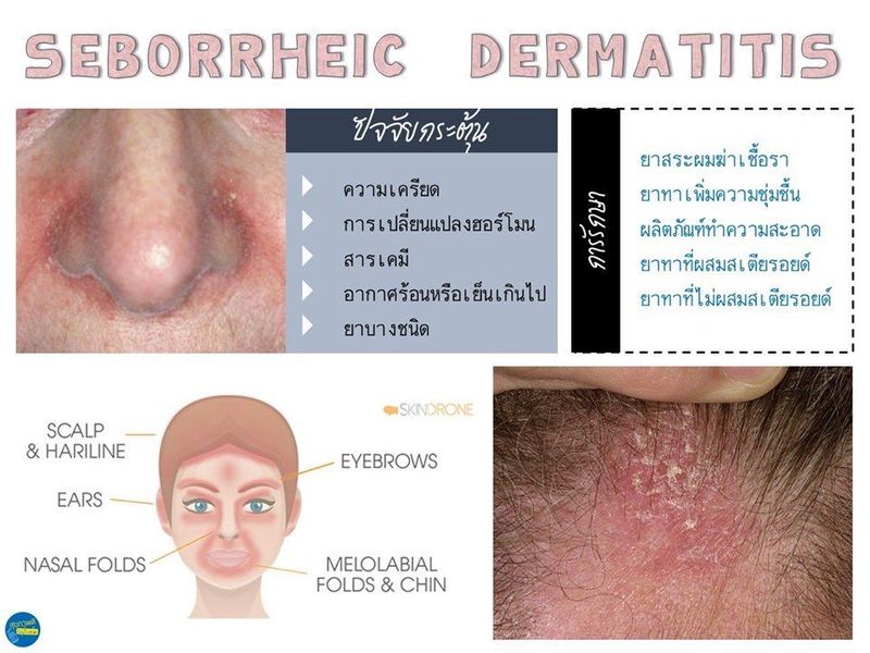 [สุขภาพดีไม่มีในขวด] Seborrheic Dermatitis หรือที่เรียกย่อๆว่า เซ็ปเด ...
