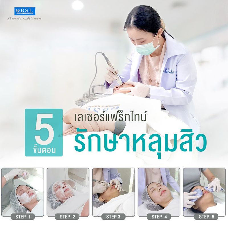 [BSL Clinic] 5 ขั้นตอนการทำ "เลเซอร์แฟร็กไทน์" รักษาหลุมสิว เพื่อผิว ...