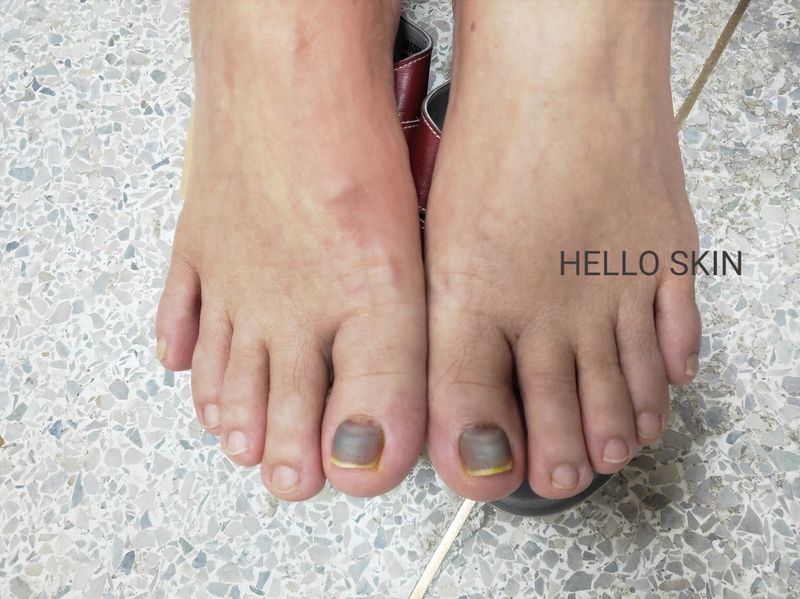 [HELLO SKIN by หมอผิวหนัง] #ภาวะเลือดออกใต้เล็บนิ้วหัวแม่เท้า หรือ ...