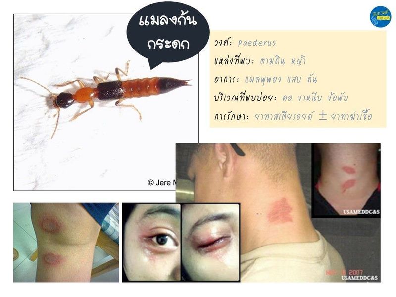 [สุขภาพดีไม่มีในขวด] พิษจากแมลงก้นกระดก แมลงก้นกระดกคือสัตว์จำพวกแมลง ...