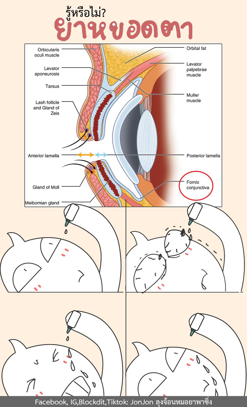 [พี่จ้วน] - Cul-de-sac (Fornix conjunctiva) ของตาซึ่งเป็นส่วนทบของเยื่อ ...
