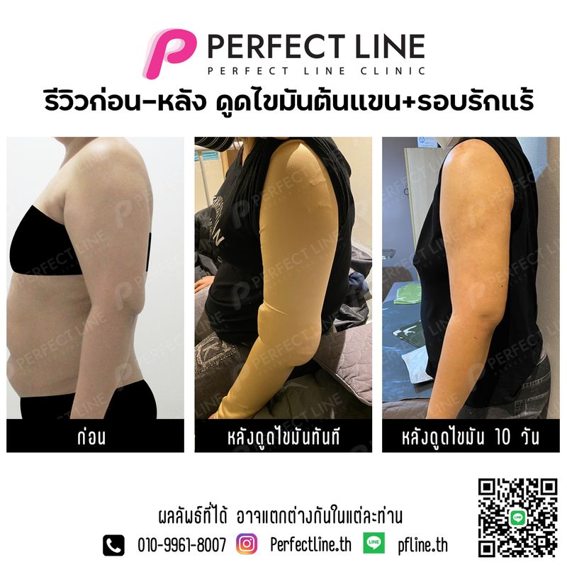[คลินิกดูดไขมัน Perfect Line - Perfect Line Clinic] วันนี้คุณลูกค้ามา ...