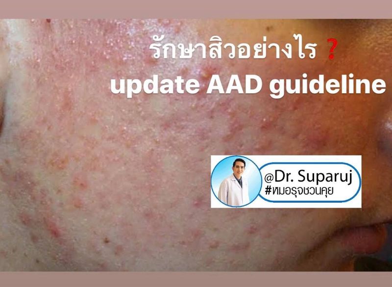 [หมอรุจชวนคุย Dr. Suparuj ผมผิวสิวหลุมสิวแผลเป็น] 📍รักษาสิวอย่างไร update AAD guideline รอยหลัง ...