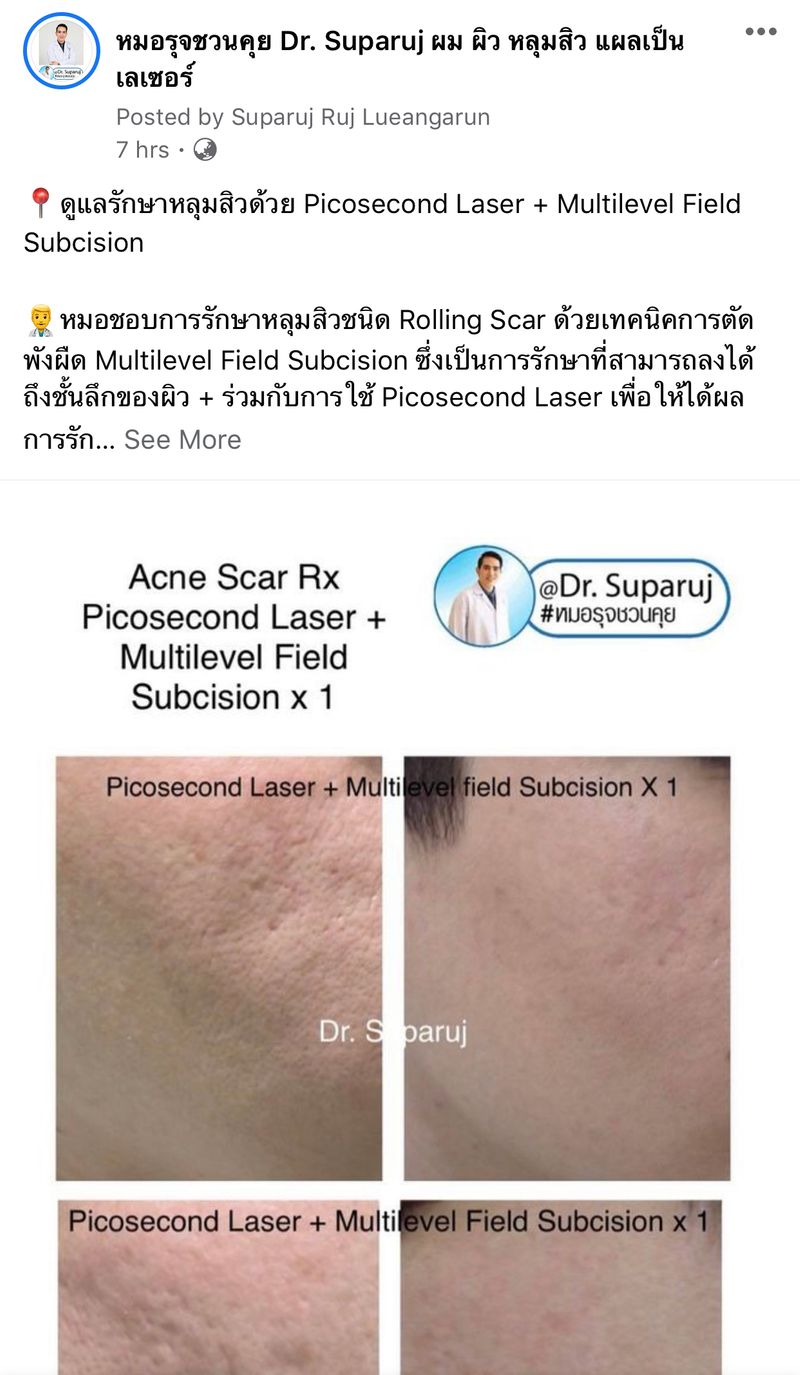 [หมอรุจชวนคุย Dr. Suparuj ผมผิวสิวหลุมสิวแผลเป็น] 📍ดูแลรักษาหลุมสิวด้วย ...