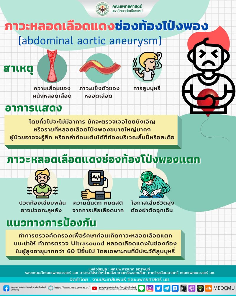 [MedCMU] ภาวะหลอดเลือดแดงช่องท้องโป่งพอง (abdominal aortic aneurysm ...