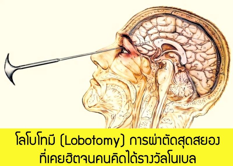 [อาจวรงค์ จันทมาศ] โลโบโทมี (Lobotomy) การผ่าตัดสุดสยองที่เคยฮิตจนคนคิด ...