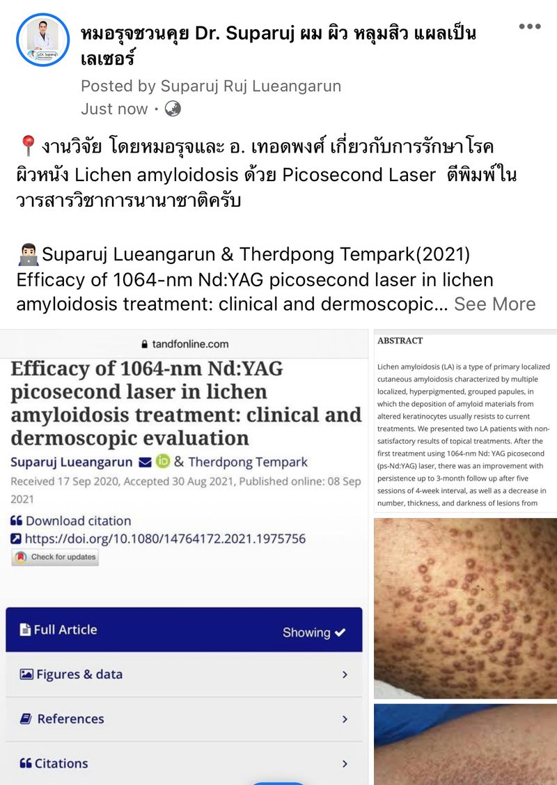 [หมอรุจชวนคุย Dr. Suparuj ผมผิวสิวหลุมสิวแผลเป็น] 📍งานวิจัย โดยหมอรุจและ รศ. นพ. เทอดพงศ์ ...