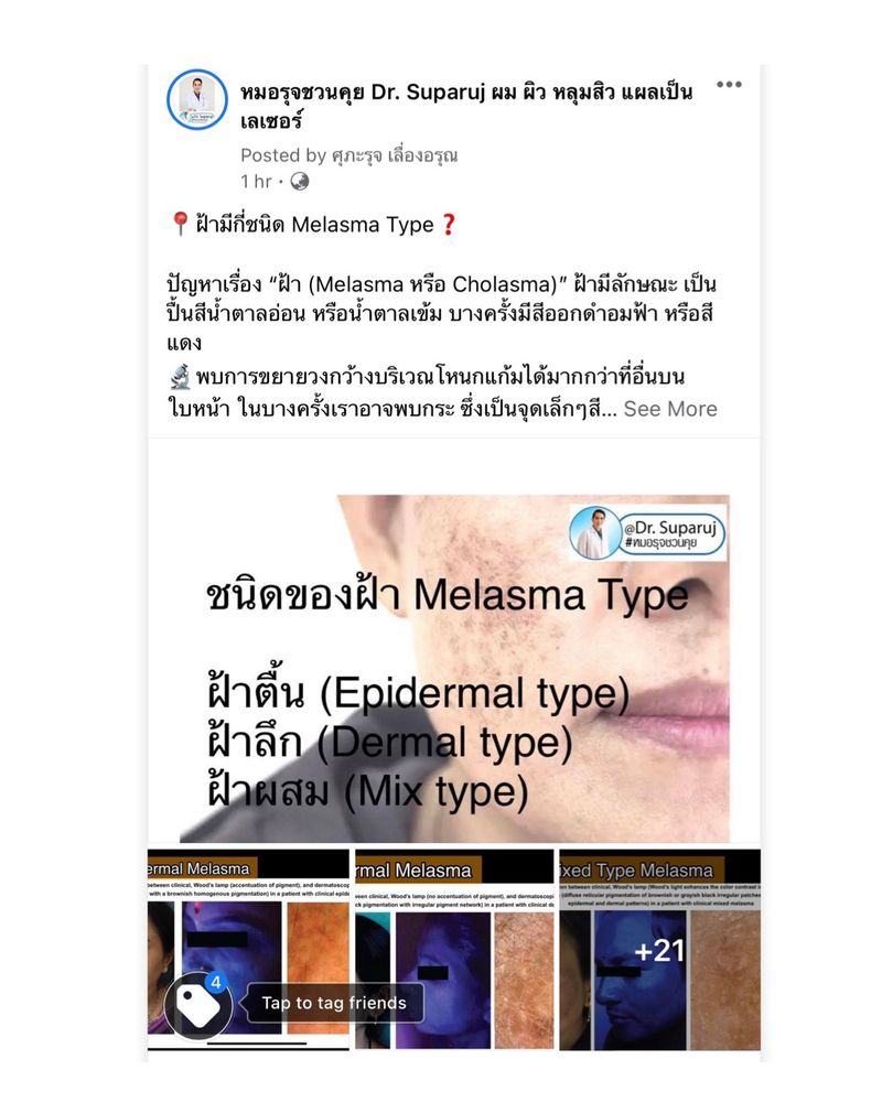 หมอรุจชวนคุย Dr. Suparuj ผมผิวสิวหลุมสิวแผลเป็น