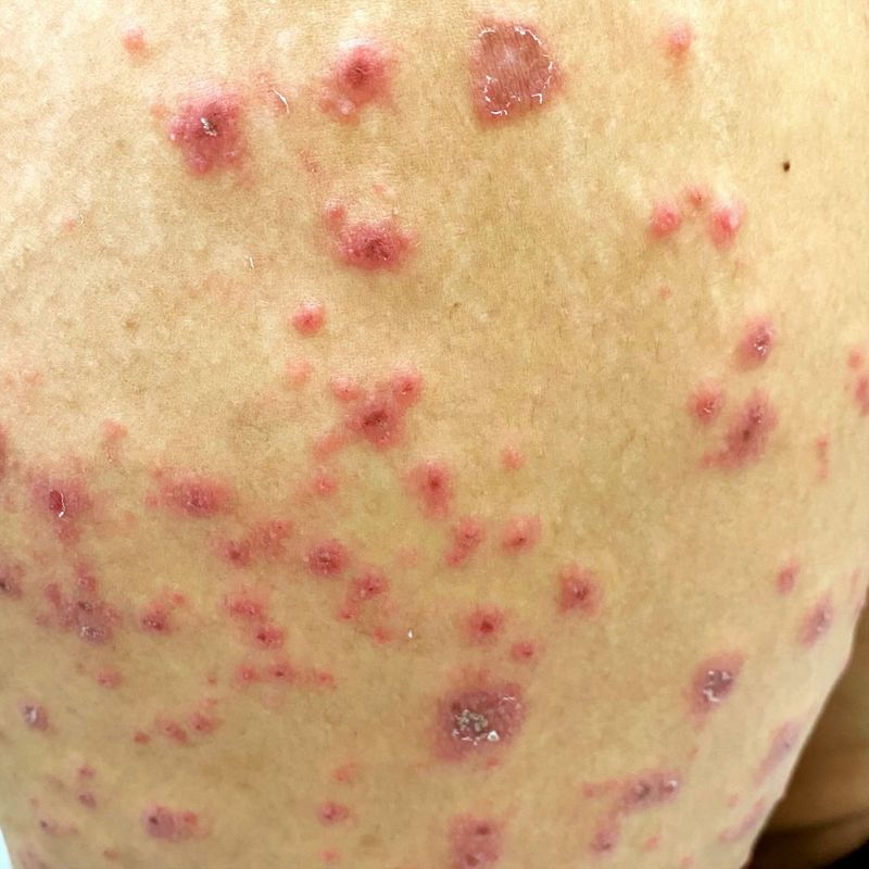 [Cloud Skin by Dr. KADE] Pityriasis lichenoides et varioliformis acuta ...