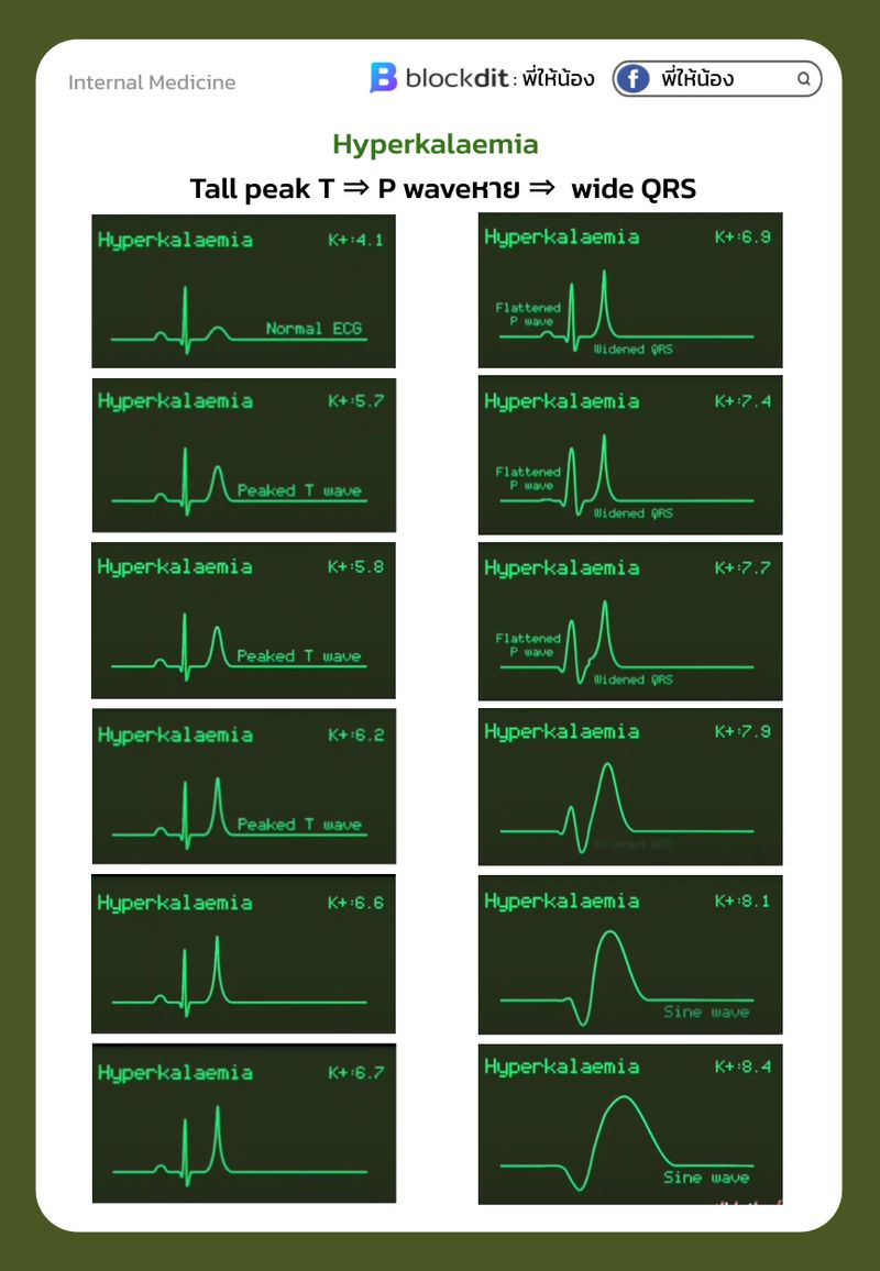 [พี่ให้น้อง] วันนี้มาดู progression ของECG features of hyperkalemiaกัน ...