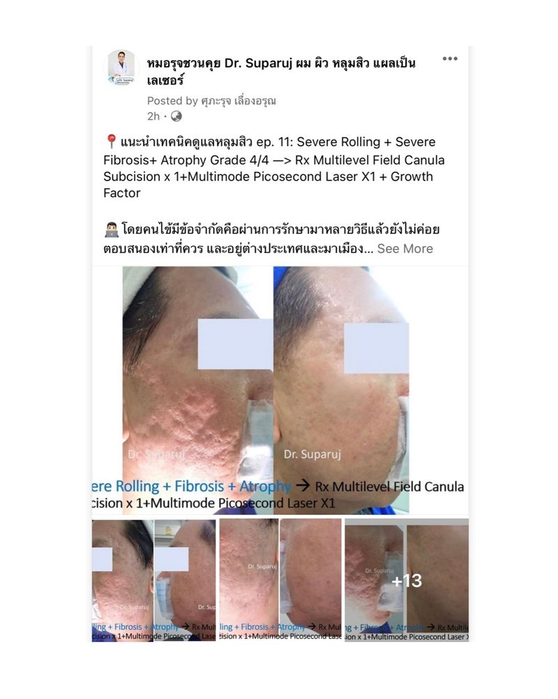 [หมอรุจชวนคุย Dr. Suparuj ผมผิวสิวหลุมสิวแผลเป็น] 📍แนะนำเทคนิคดูแลหลุมสิว ep. 11: Severe Rolling ...