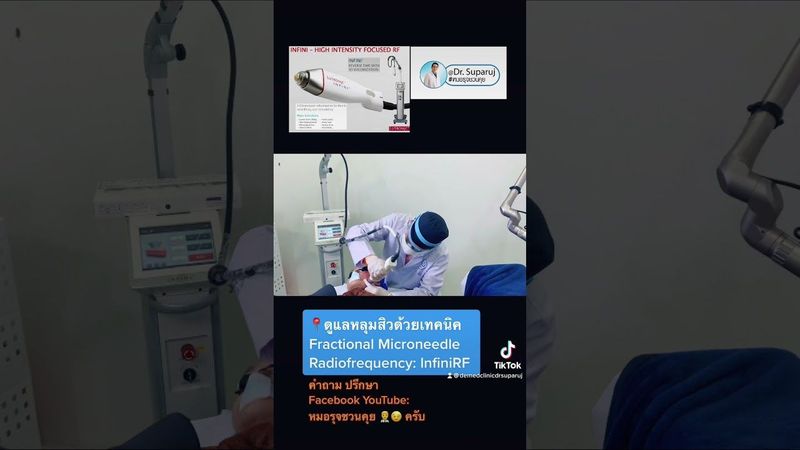 [หมอรุจชวนคุย Dr. Suparuj ผมผิวสิวหลุมสิวแผลเป็น] 📍ดูแลหลุมสิวด้วยเทคนิค Fractional Microneedle ...