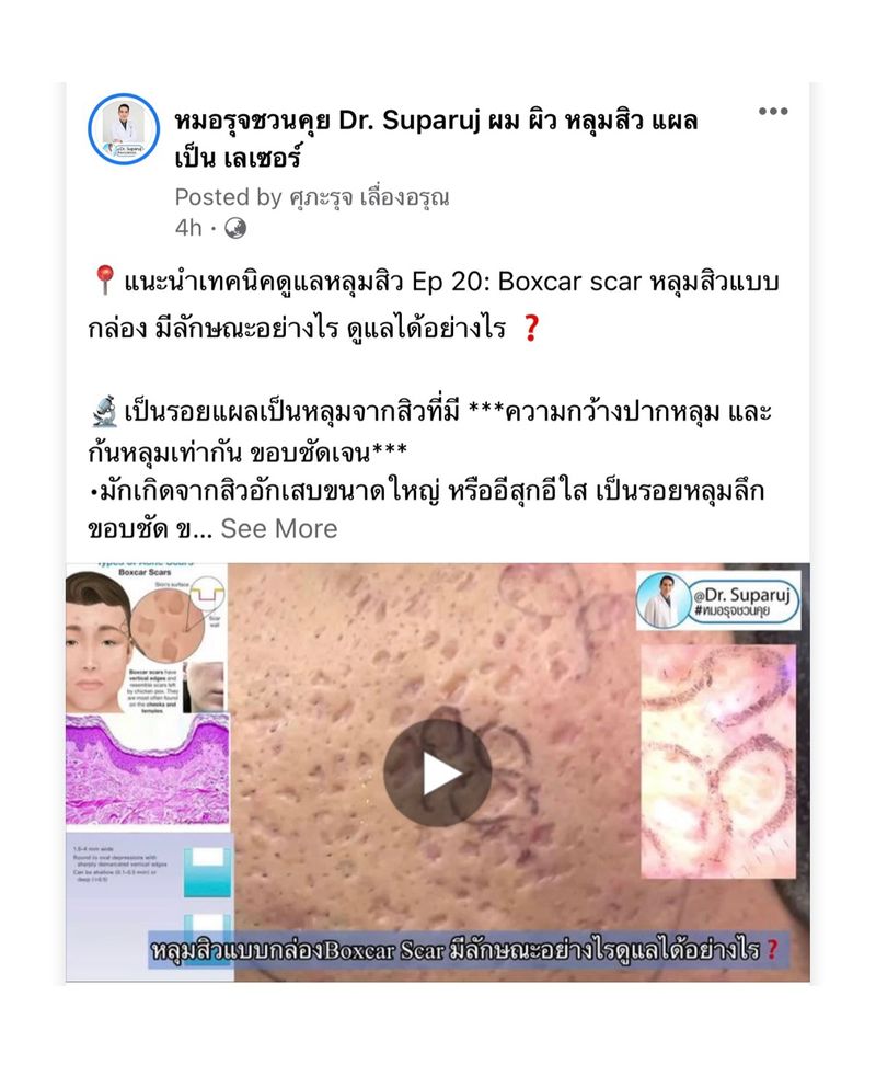 [หมอรุจชวนคุย Dr. Suparuj ผมผิวสิวหลุมสิวแผลเป็น] 📍แนะนำเทคนิคดูแลหลุมสิว Ep 20: Boxcar scar ...