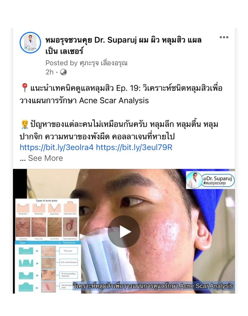 [หมอรุจชวนคุย Dr. Suparuj ผมผิวสิวหลุมสิวแผลเป็น] 📍แนะนำเทคนิคดูแลหลุมสิว Ep. 19: วิเคราะห์ชนิด ...