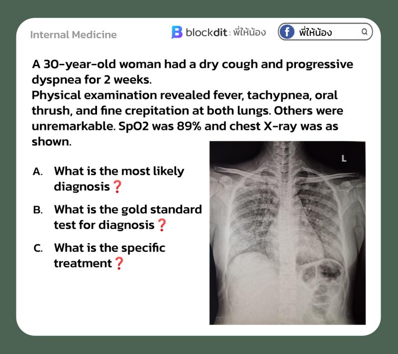 [พี่ให้น้อง] A 30-year-old woman had a dry cough and progressive ...