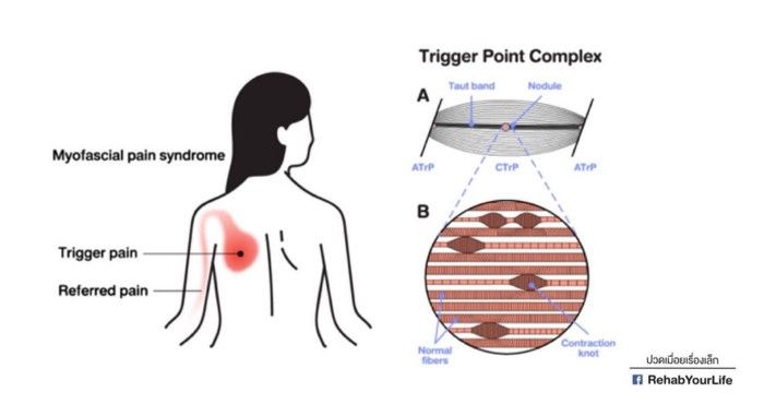 [Rehab Your Life ปวดเมื่อยเรื่องเล็ก] มารู้จัก Trigger point กัน คนไข้ ...