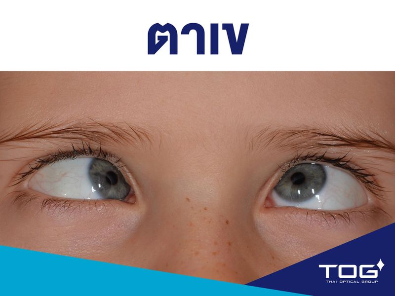 [Thai Optical Group] ข้อมูลโรคทางสายตา ตาเข และ สายตาเอียง ตาเข คือ ...