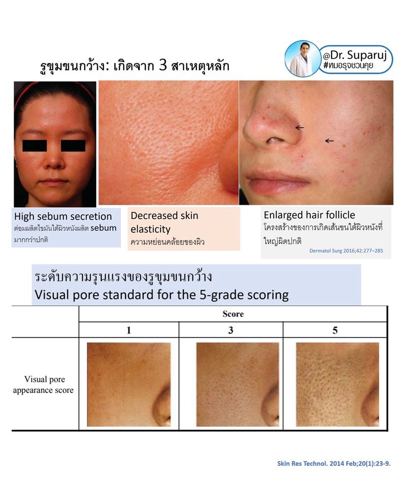 [หมอรุจชวนคุย Dr. Suparuj ผมผิวสิวหลุมสิวแผลเป็น] 📍รูขุมขนกว้าง Enlarged facial Pore เกิดจากอะไร ...