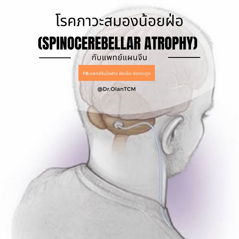 [บ้านหมอตั้ม] โรคภาวะสมองน้อยฝ่อ หรือที่เรียกว่า spinocerebellar ...