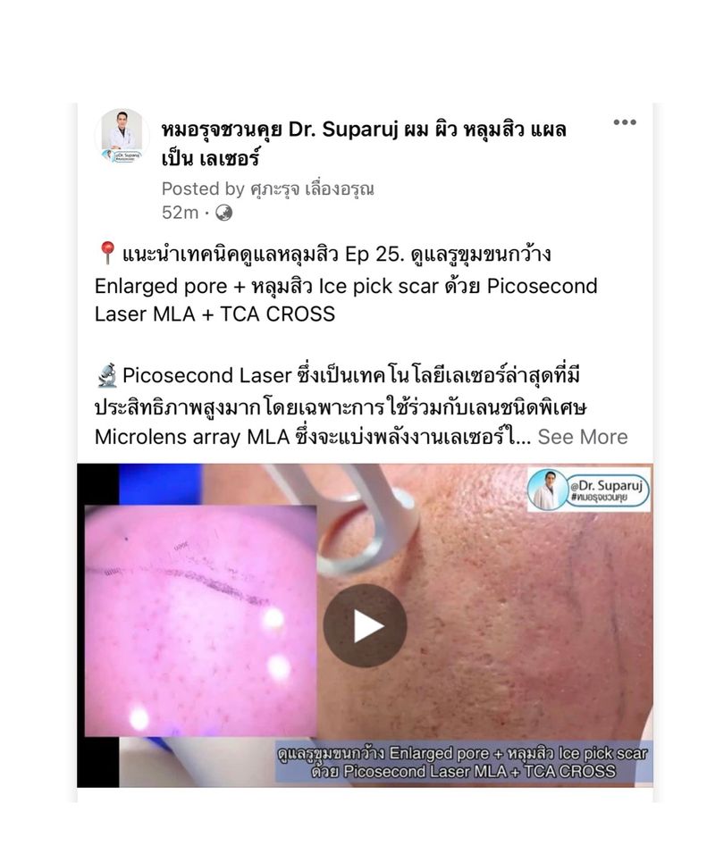 [หมอรุจชวนคุย Dr. Suparuj ผมผิวสิวหลุมสิวแผลเป็น] 📍แนะนำเทคนิคดูแลหลุมสิว Ep 25. ดูแลรูขุมขน ...