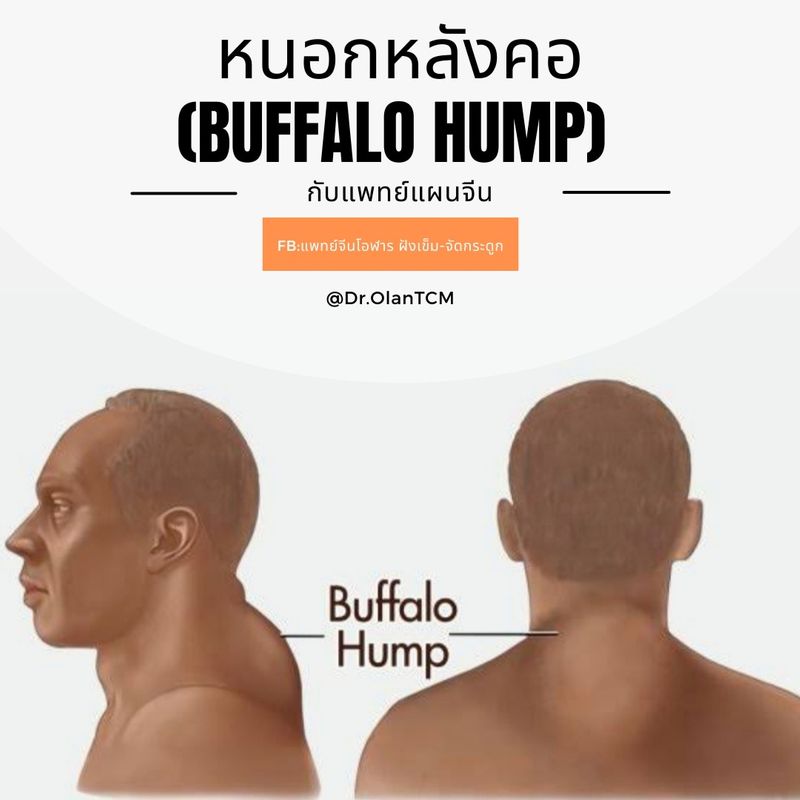 [บ้านหมอตั้ม] หนอกหลังคอ Buffalo hump หนอกหลังคอ หรือ Buffalo hump เป็น ...