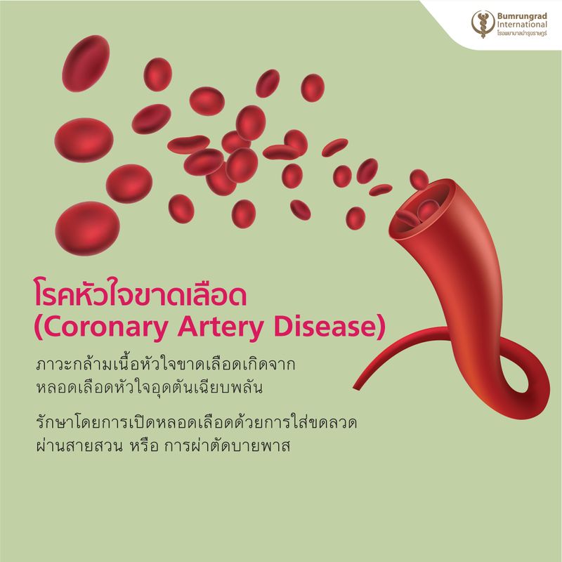 [Bumrungrad International] รู้เท่าทันภัยเงียบจากโรคหลอดเลือดหัวใจ โรค ...