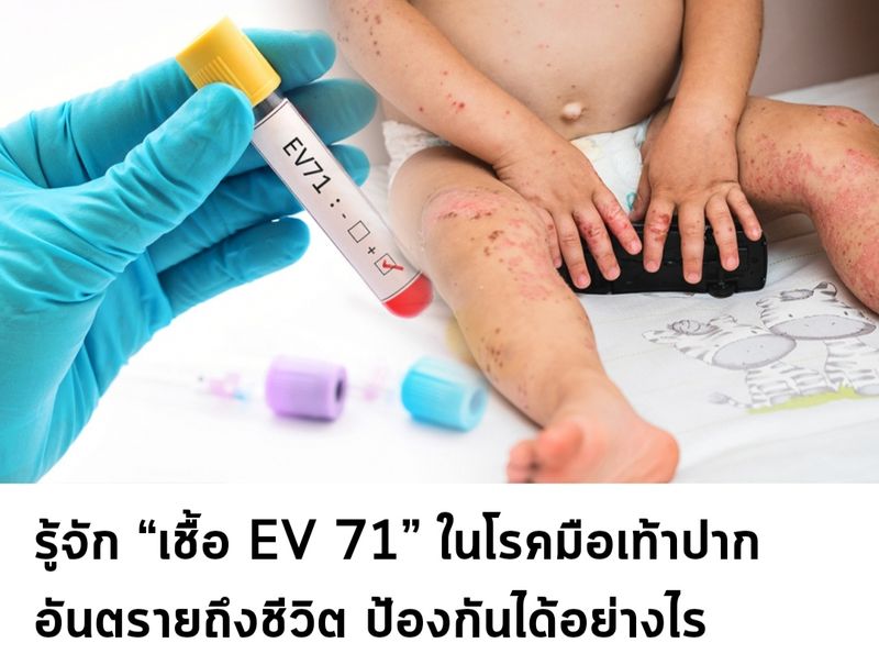 [ หมอภูมิแพ้หมอฉัฐฐิมา] #EV71? อีวี71ย่อมาจากEnterovirus71 ซึ่งเป็นหนึ่งในสาเหตุของการเกิดโรคมือ ...