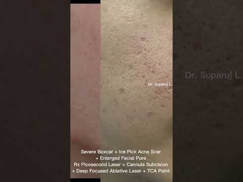 [DeMed Skin Product เวชสำอางคุณภาพ สิว ฝ้า ผมร่วง] 📍แนะนำเทคนิคดูแลหลุม ...