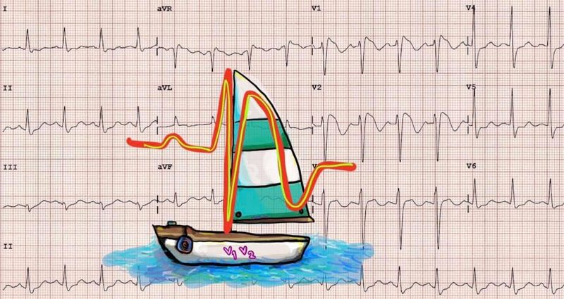 [ห้องฉุกเฉินต้องรู้] Brugada Syndrome, Coved pattern Type I ~ บรูกาด้า ...