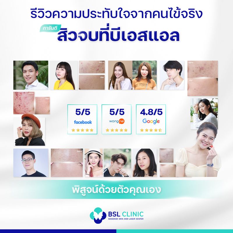 [BSL Clinic] 👨‍🔬 รีวิวความประทับใจ การันตี #สิวจบที่บีเอสแอล 👨‍🔬 ปรึกษา ...