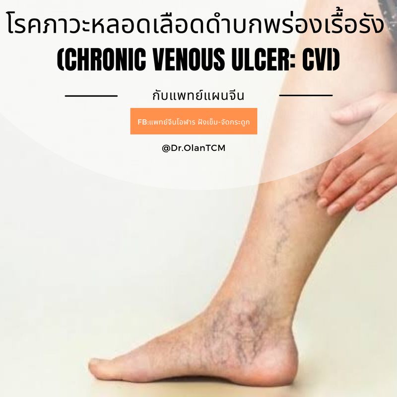 [บ้านหมอตั้ม] โรคภาวะหลอดเลือดดำบกพร่องเรื้อรัง (Chronic Venous Ulcer: CVI) โรคภาวะหลอดเลือดดำ ...