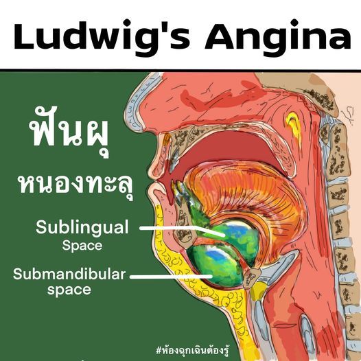 [ห้องฉุกเฉินต้องรู้] ฟันผุ หนองทะลุคางบวม ลิ้นตก หายใจไม่ออก ติดเชื้อใน ...