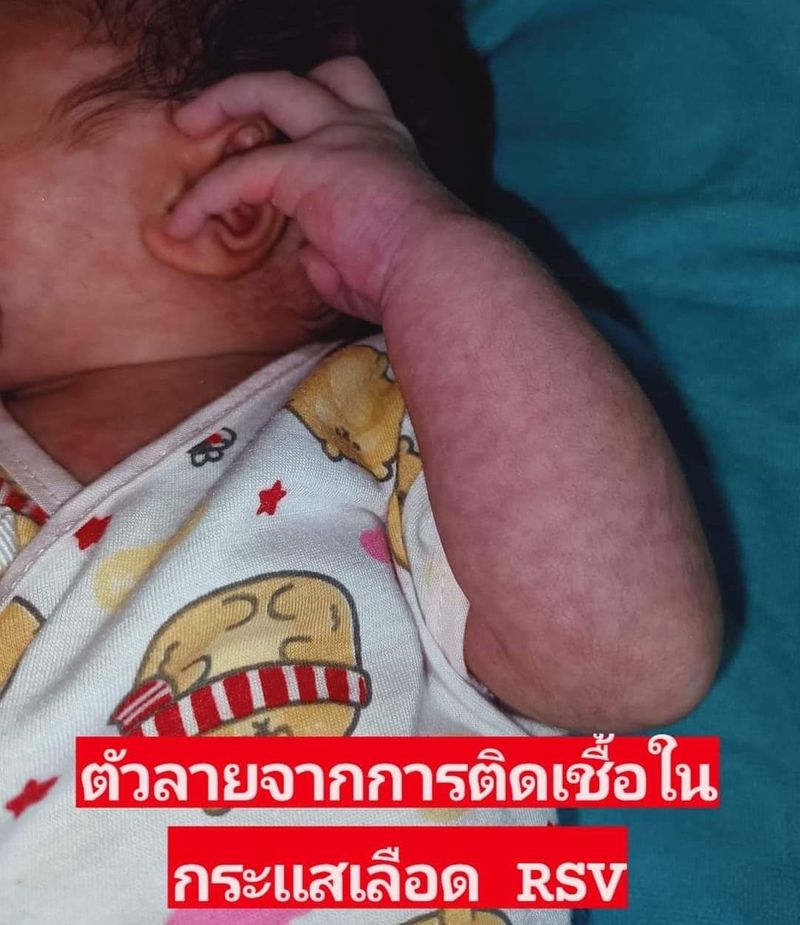 [สารพันปัญหาเลี้ยงลูก] #ขอบคุณแม่ที่มาเล่าอาการน้องแรกเกิดติดRSV 1. ไอเป็นชุดๆ ติดๆ กัน 2. มี ...