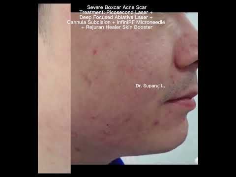 [DeMed Clinic ดูแลผิวสิวแผลเป็นหลุมสิวเส้นผม] 📍แนะนำเทคนิคดูแลหลุมสิว ...