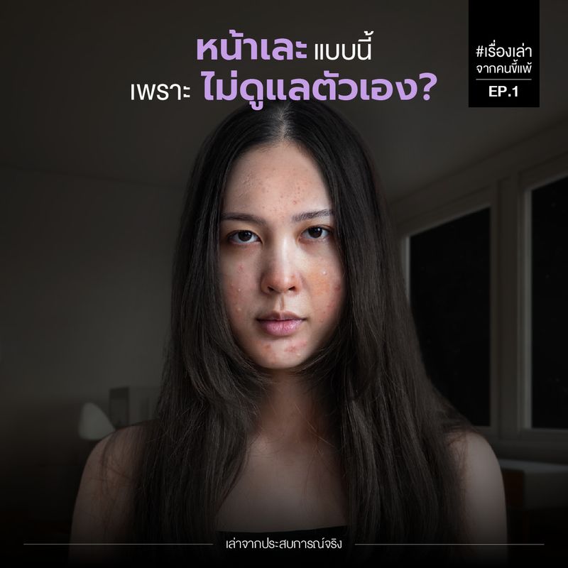 [ASTELLA คืนความมั่นใจให้คนผิวแพ้ง่าย โรซาเชีย] ไปทำอะไรมา หน้าเละ สิว ...