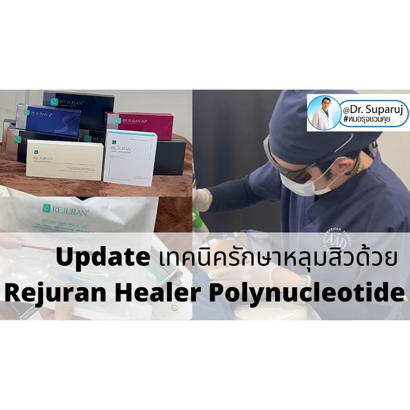 [หมอรุจชวนคุย Dr. Suparuj ผมผิวสิวหลุมสิวแผลเป็น] 📍แนะนำเทคนิคดูแลหลุม ...