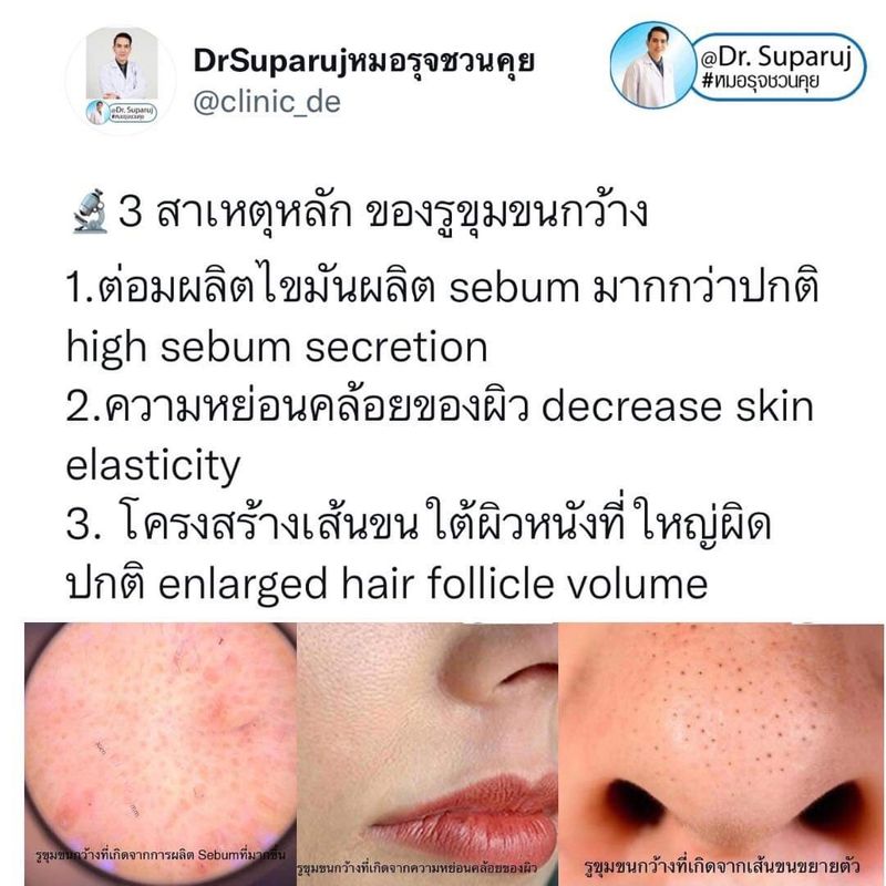 [หมอรุจชวนคุย Dr. Suparuj ผมผิวสิวหลุมสิวแผลเป็น] 📍รูขุมขนกว้าง Enlarged Facial Pore เกิดจากอะไร ...