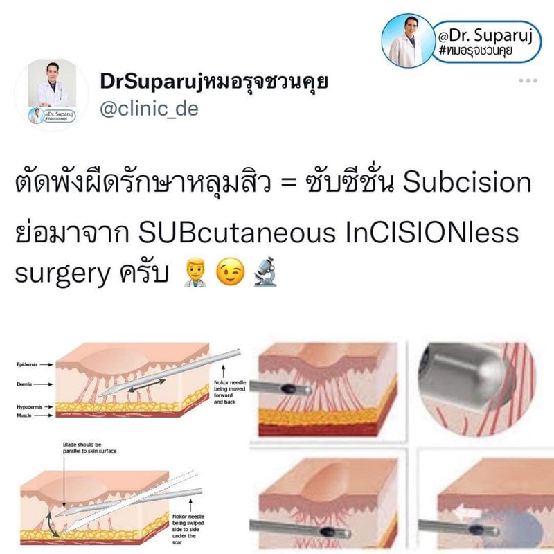 [DeMed Skin Product เวชสำอางคุณภาพ สิว ฝ้า ผมร่วง] 📍ตัดพังผืดรักษาหลุม ...