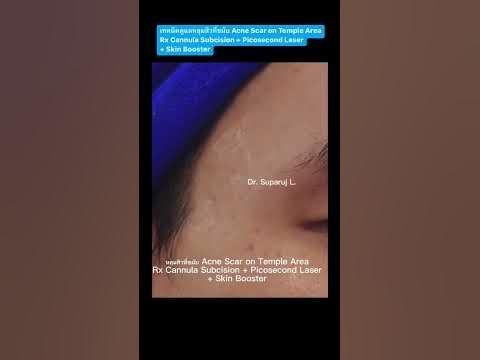 [DeMed Clinic ดูแลผิวสิวแผลเป็นหลุมสิวเส้นผม] 📍แนะนำเทคนิคดูแลหลุมสิว ...