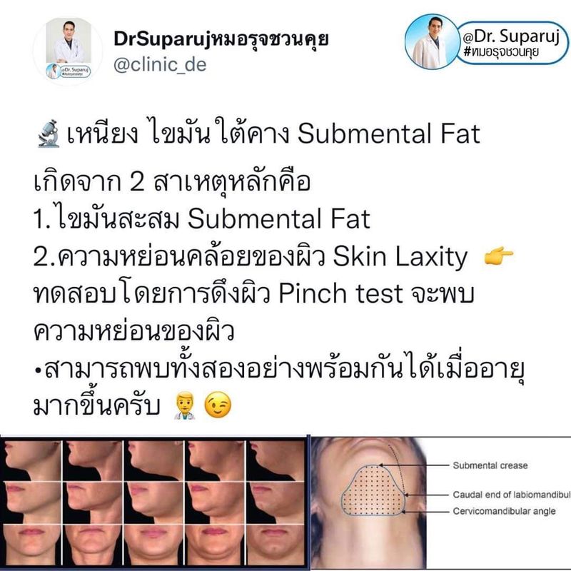 [หมอรุจชวนคุย Dr. Suparuj ผมผิวสิวหลุมสิวแผลเป็น] 🔬เหนียง ไขมันใต้คาง ...