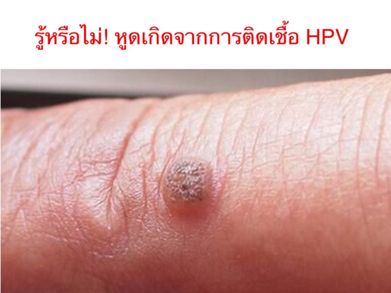 [หมอเฝิง แพทย์แผนจีน] รู้หรือไม่! หูเเกิดจากการติดเชื้อ HPV หูด (warts) เป็นโรคผิวหนังชนิดหนึ่ง ...