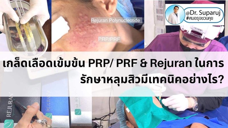 [หมอรุจชวนคุย Dr. Suparuj ผมผิวสิวหลุมสิวแผลเป็น] 📍Update เทคนิคดูแลหลุมสิวด้วย Rejuran และ ...