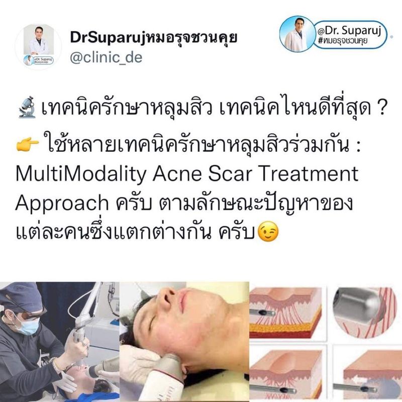 [หมอรุจชวนคุย Dr. Suparuj ผมผิวสิวหลุมสิวแผลเป็น] 🔬เทคนิครักษาหลุมสิว เทคนิคไหนดีที่สุด ? 👉ใช้ ...