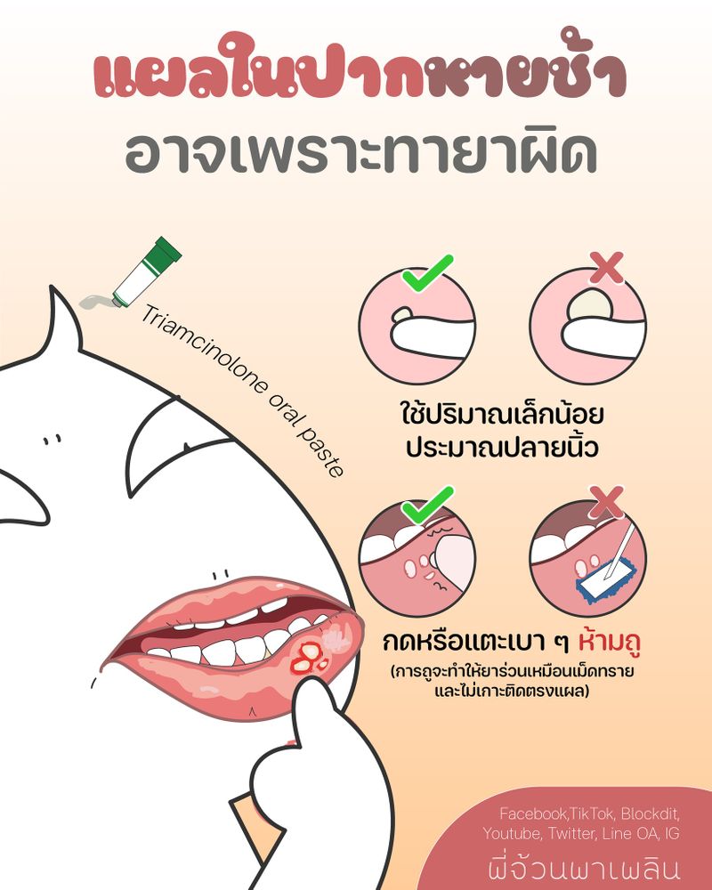 [จ้วนพาเพลิน] แผลในปากหายช้า อาจทายาผิด? Triamcinolone (Triamcinolone ...