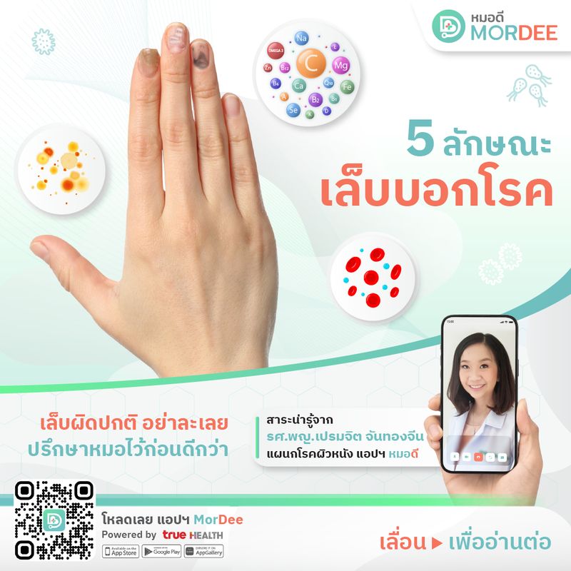 [MorDee - หมอดี] 5 ลักษณะ #เล็บบอกโรค 💅 สัญญาณภายนอก ที่บอกว่าร่างกาย “ไม่โอเค”