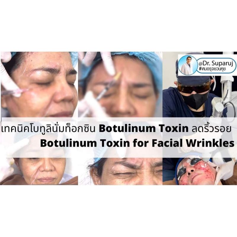 [DeMed Skin Product เวชสำอางคุณภาพ สิว ฝ้า ผมร่วง] 📍เทคนิคโบทูลินั่มท็ ...