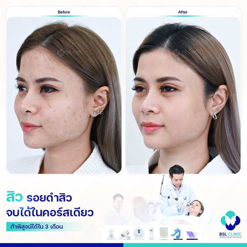 [BSL Clinic] 🎉 สิว รอยดำสิว จบได้ในคอร์สเดียว ท้าพิสูจน์ได้ใน 3 เดือน 🎉 ...