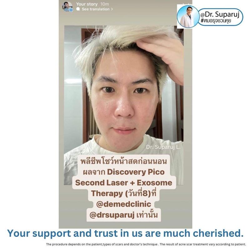 [หมอรุจชวนคุย Dr. Suparuj ผมผิวสิวหลุมสิวแผลเป็น] 📍แนะนำเทคนิคดูแลหลุมสิว Update ผลการรักษาหลุม ...