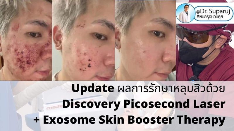 [DeMed Clinic ดูแลผิวสิวแผลเป็นหลุมสิวเส้นผม] 📍แนะนำเทคนิคดูแลหลุมสิว ...