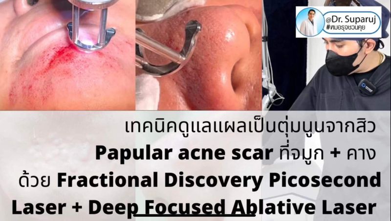 [DeMed Clinic ดูแลผิวสิวแผลเป็นหลุมสิวเส้นผม] 📍เทคนิคดูแลแผลเป็นตุ่มนูน ...